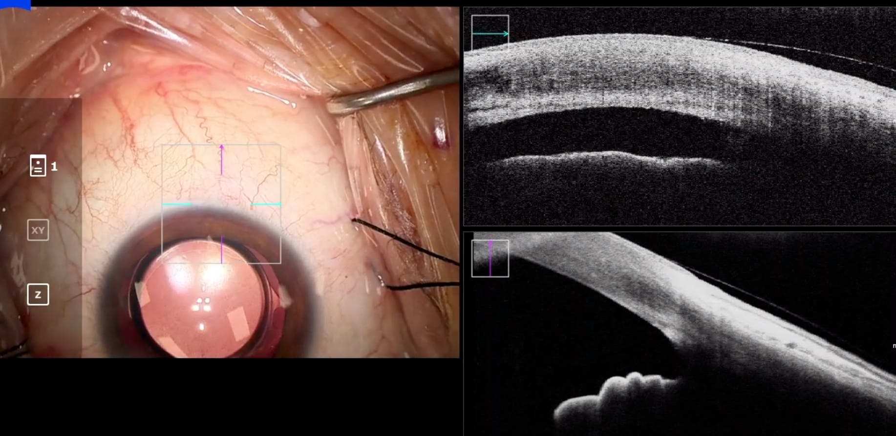 Canal Dilation With iStent Using Intraoperative OCT - Eyetube